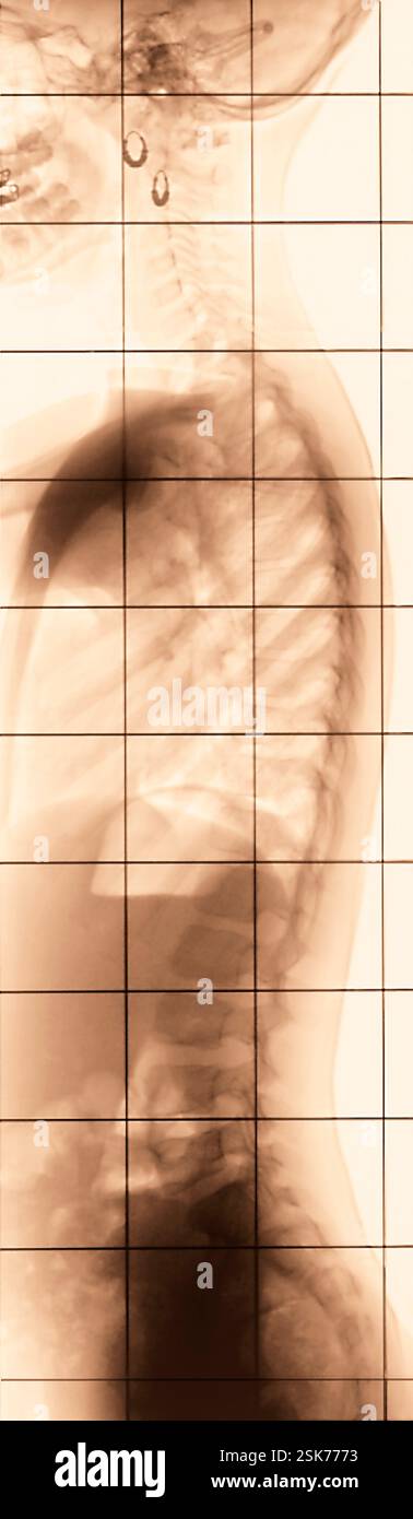 Normal spine. Coloured profile X-ray of the normal spine of a 10 year ...