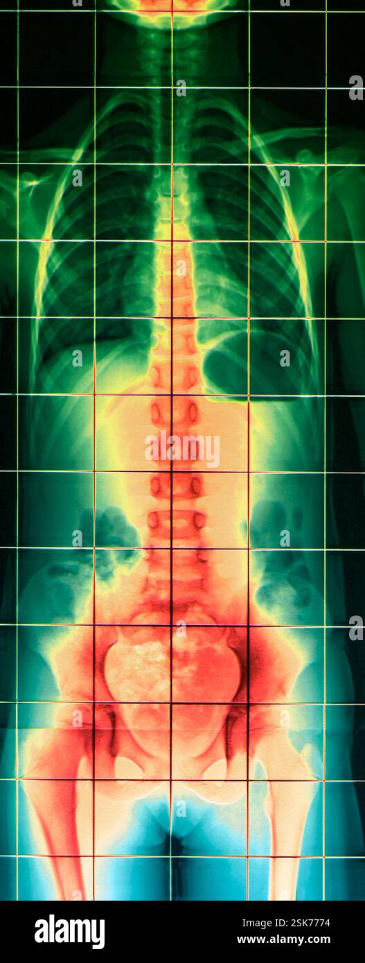 Normal spine and pelvis. Coloured frontal X-ray of the normal spine and ...