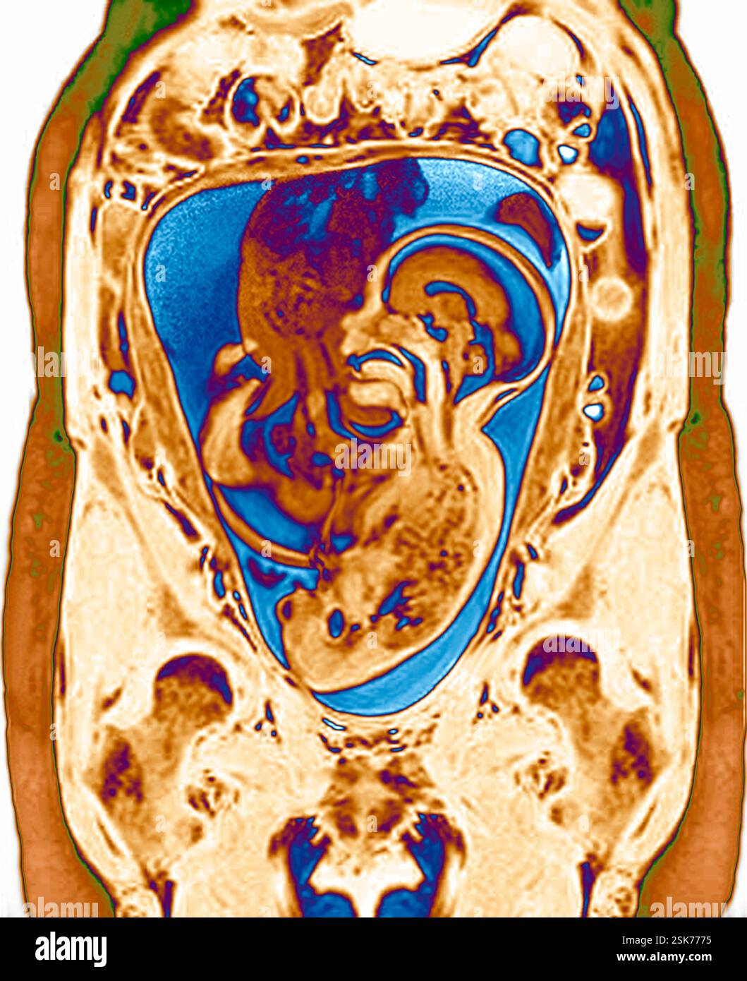 Twin foetuses. Coloured magnetic resonance imaging (MRI) scan of full ...