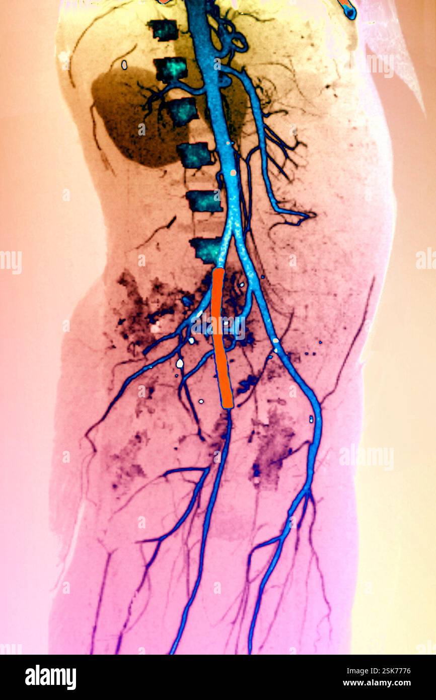 Arterial stent. Coloured frontal magnetic resonance imaging (MRI ...