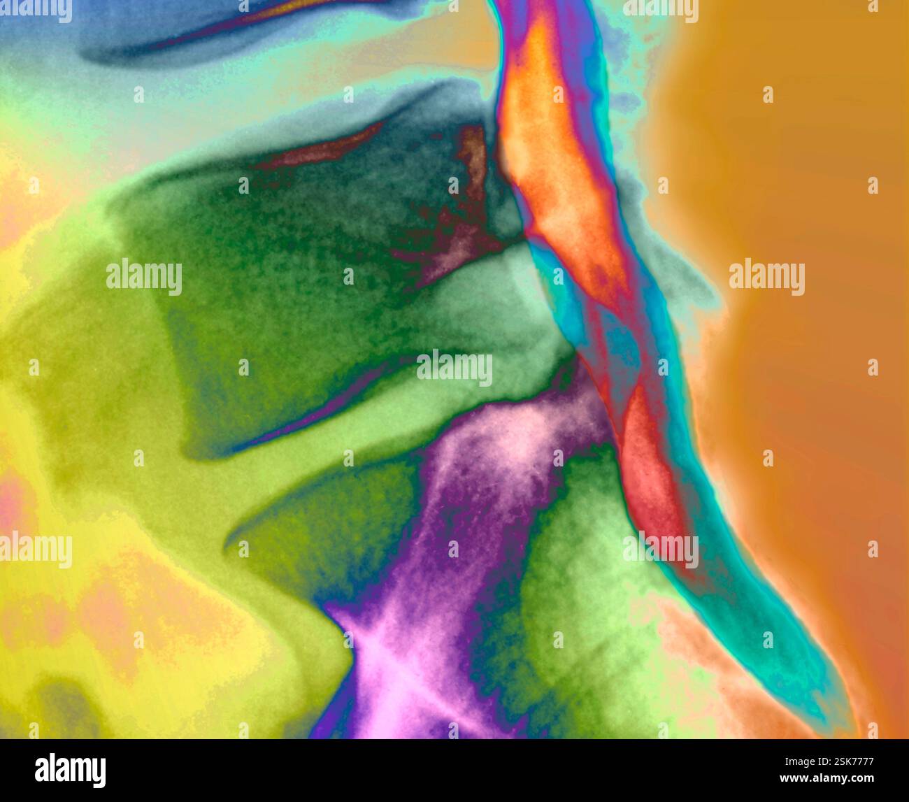 Slipped disc. Profile coloured myelogram (X-ray) of the lumbar spine ...