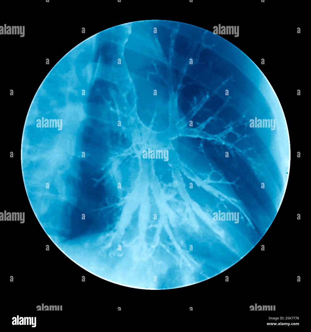 Bronchiectasis. Coloured bronchogram (X-ray) of the lung of a patient ...