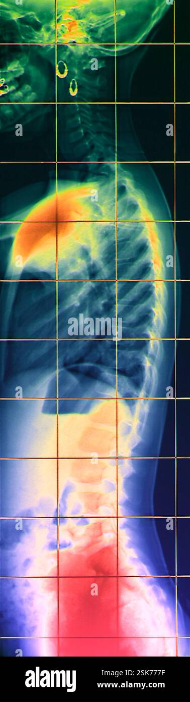 Normal spine. Coloured profile X-ray of the normal spine of a 10 year ...