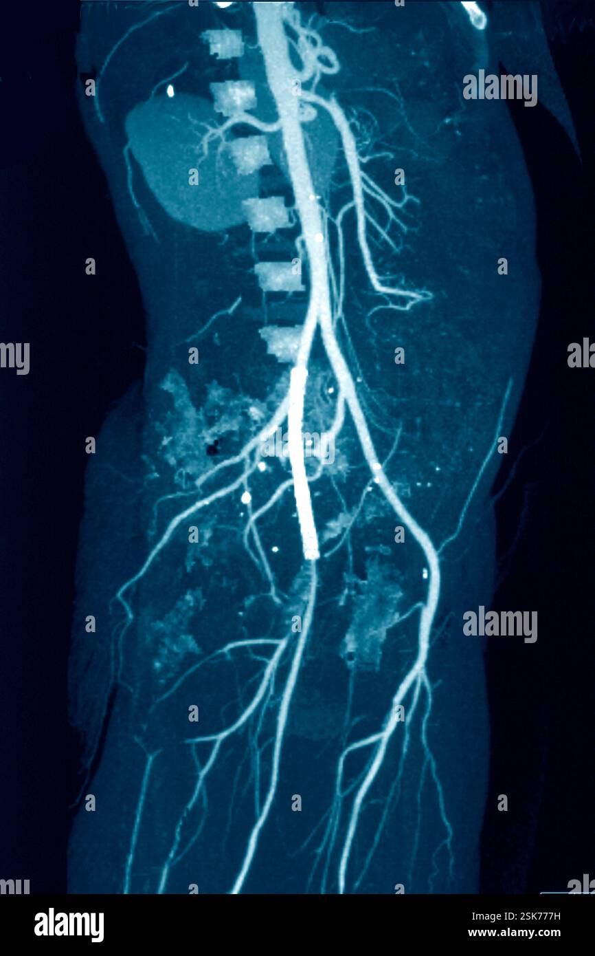 Arterial stent. Coloured profile magnetic resonance imaging (MRI ...