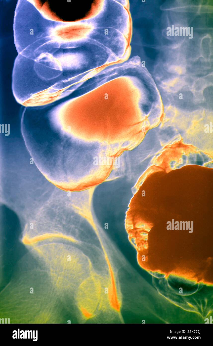 Colonic polyp, double contrast coloured barium X-ray. The polyp is the ...