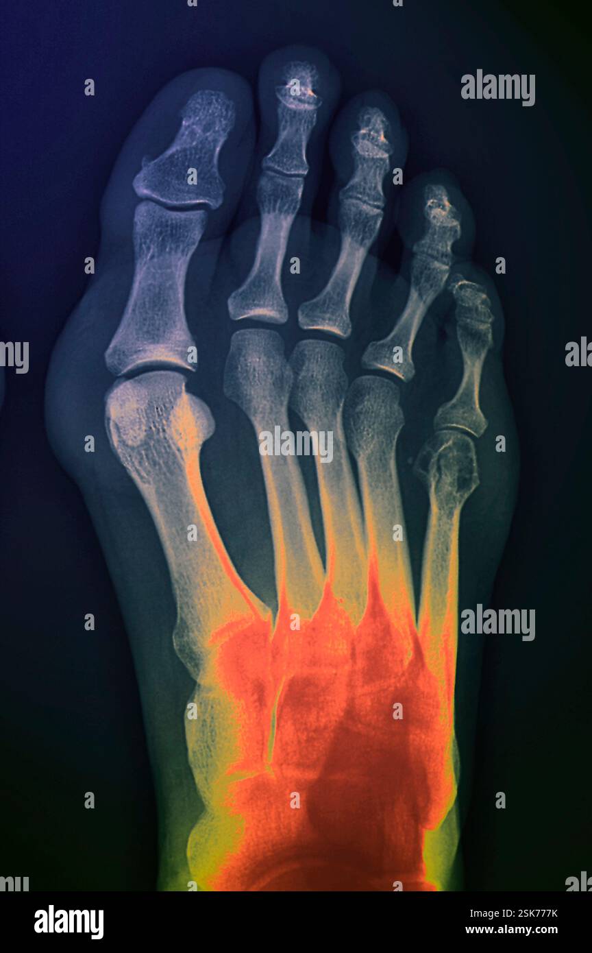 Bunion. Coloured X-ray of a bunion on a 52 year old female patient's ...