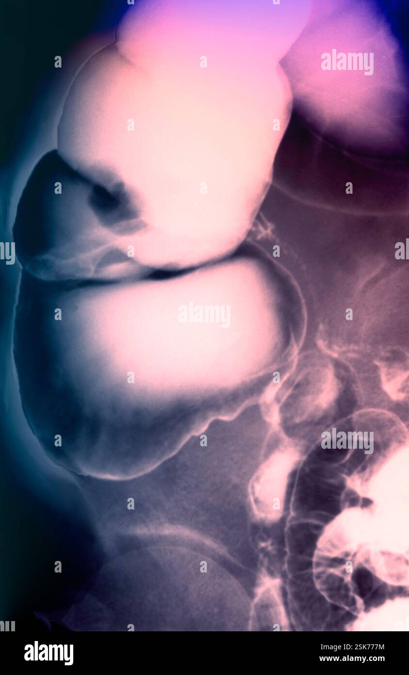 Colonic polyp, double contrast coloured barium X-ray. The polyp is the ...