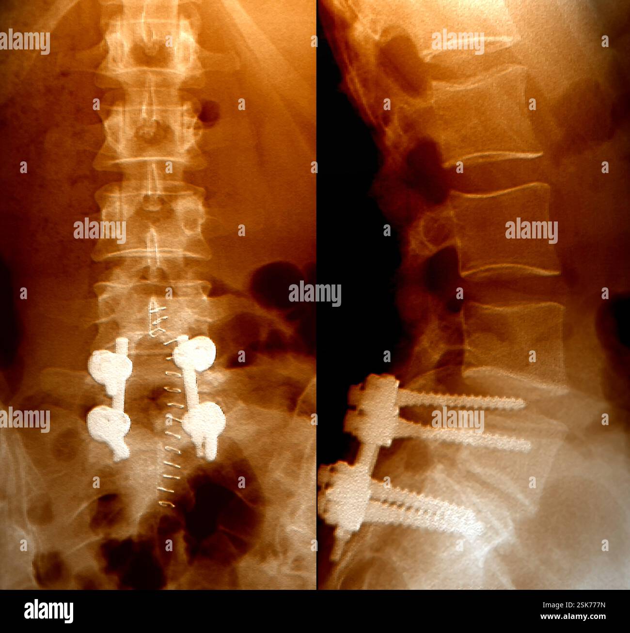 Treatment of spinal displacement. Frontal (left) and profile (right) X ...