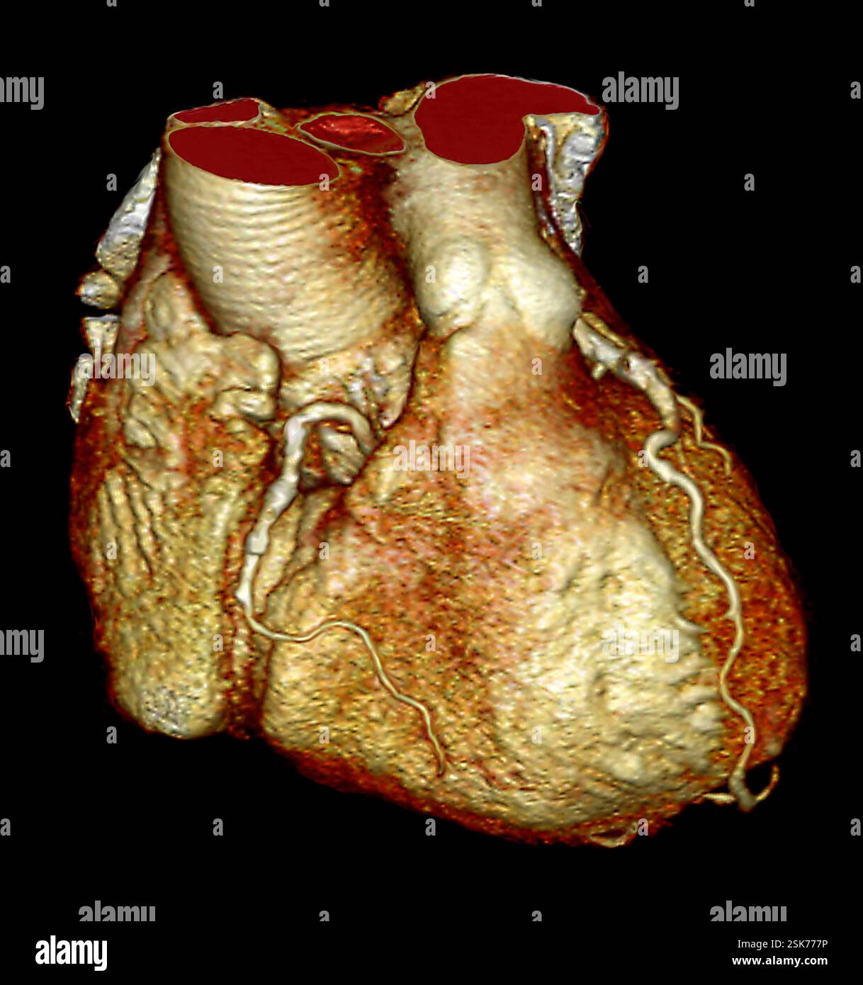 Healthy human heart. Coloured 3D computed tomography (CT) scan of the ...