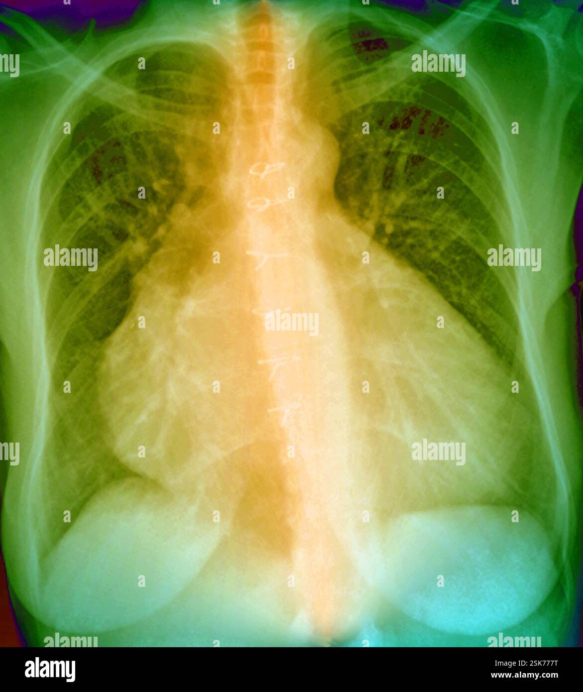 Transplanted heart. Coloured frontal X-ray of a 47-year-old woman who ...