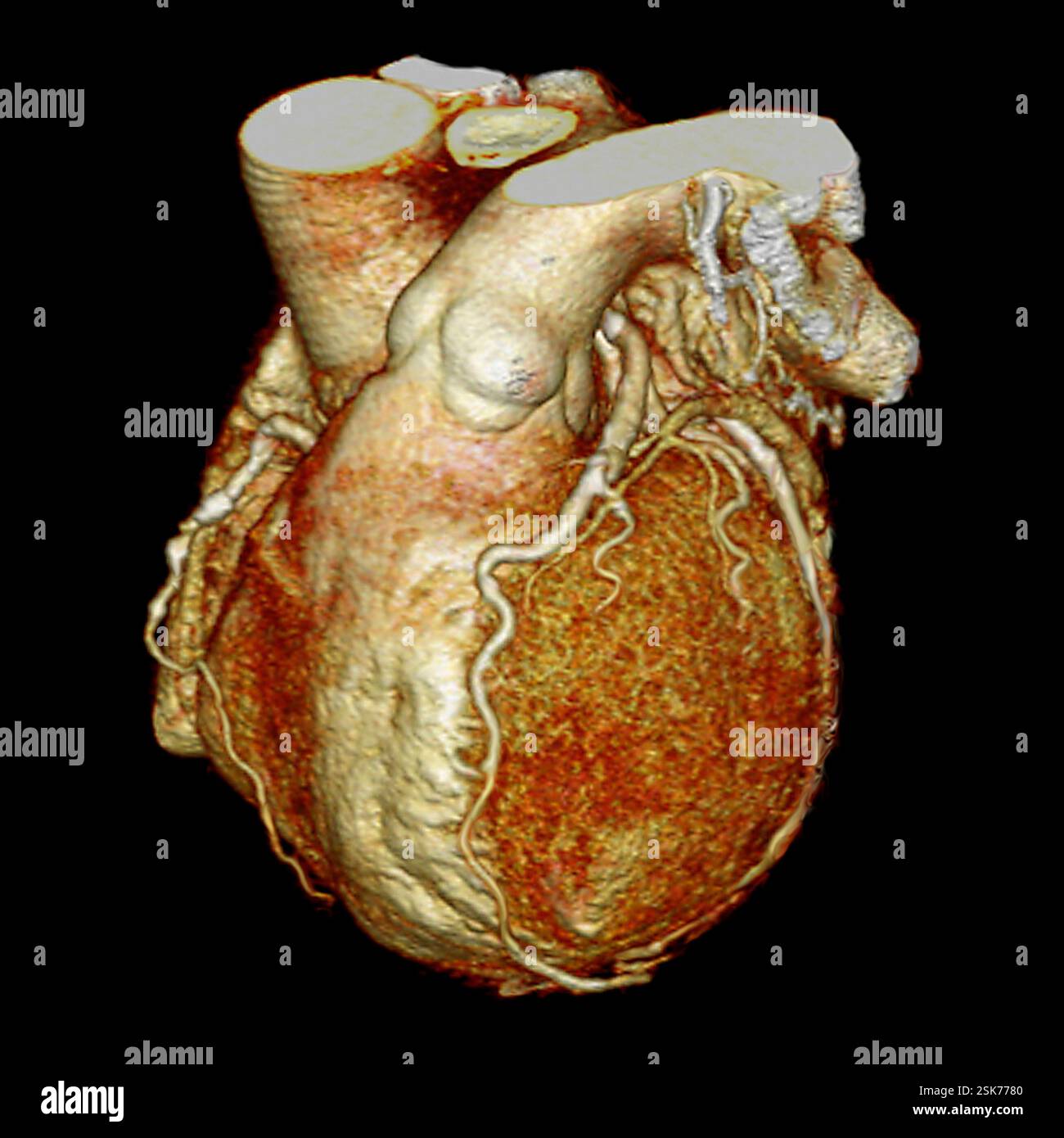 Diseased human heart, 3D CT scan Stock Photo - Alamy