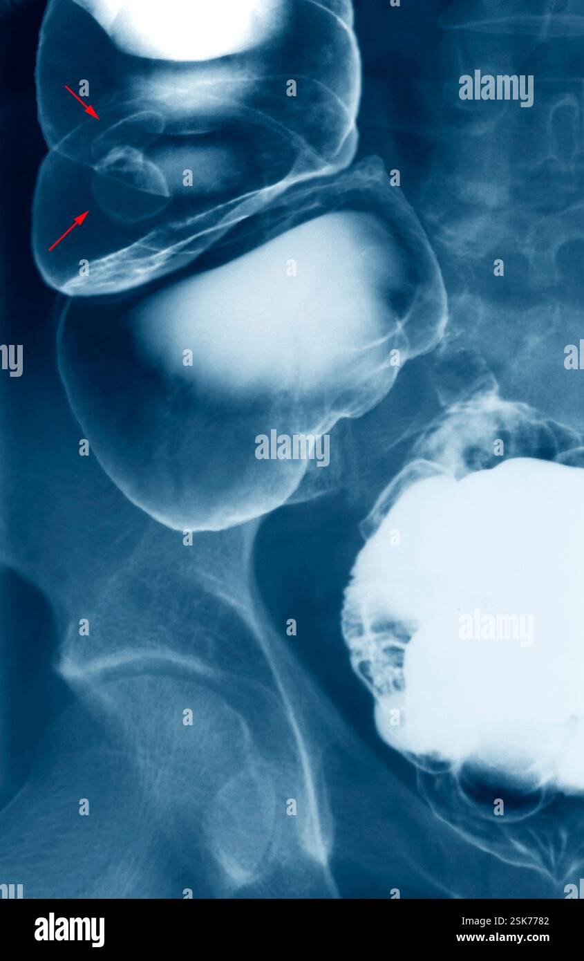 Colonic polyp, double contrast coloured barium X-ray. The polyp is ...