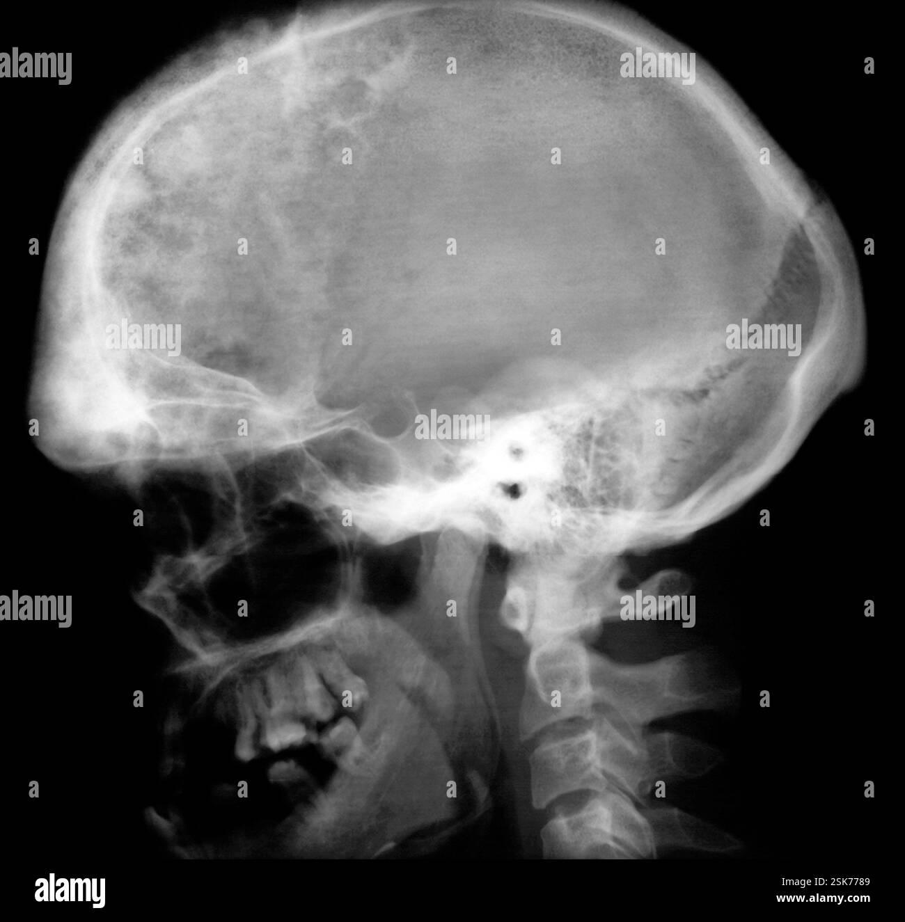 Fibrous dysplasia of the bone. Profile X-ray of the skull of a 36-year ...