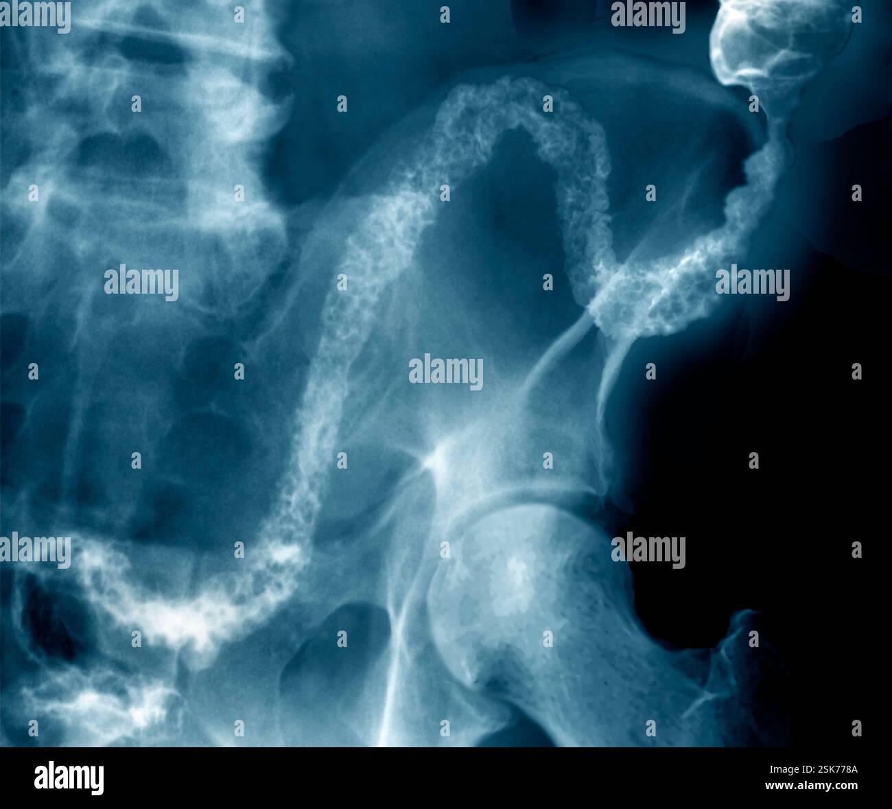 Ulcerative colitis. Coloured frontal barium X-ray of the left colon ...