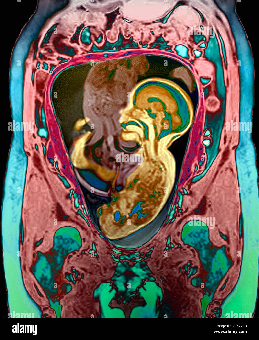 Twin foetuses. Coloured magnetic resonance imaging (MRI) scan of full ...