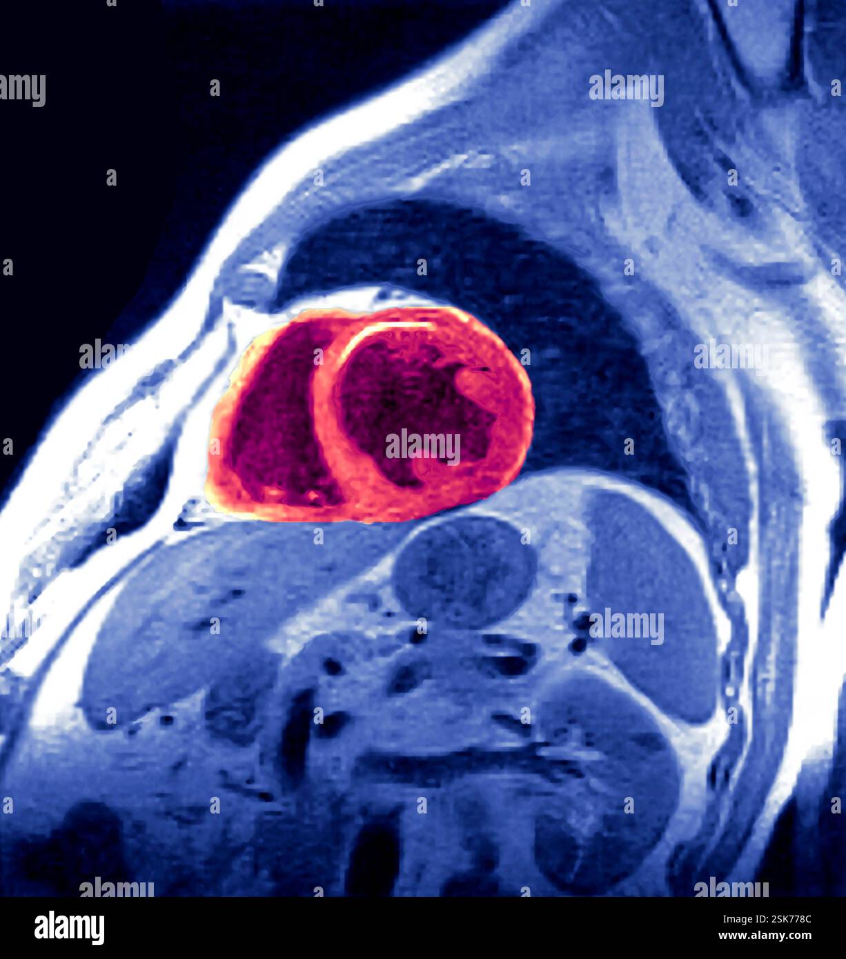 Heart disease. Coloured magnetic resonance imaging (MRI) scan of a ...