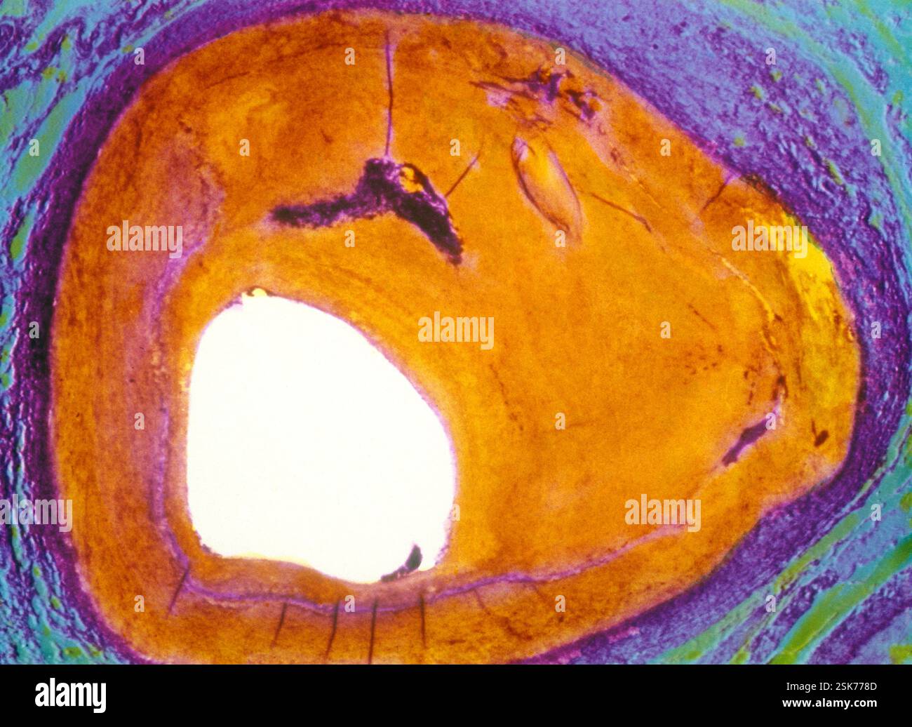 Narrowed artery. Colured light micrograph of a section through a ...