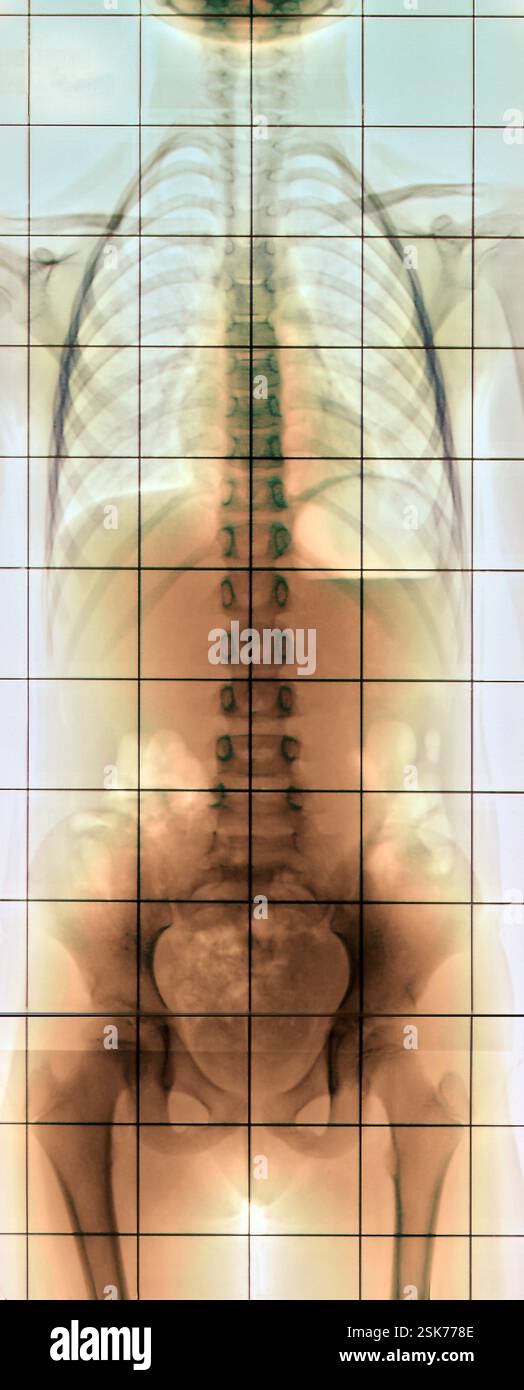Normal spine and pelvis. Coloured frontal X-ray of the normal spine and ...