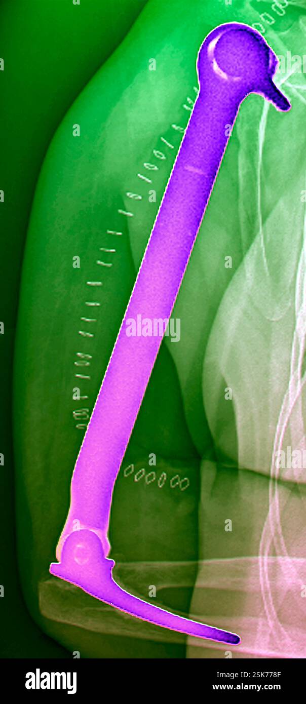 Total upper arm bone replacement. Coloured frontal X-ray of the right ...
