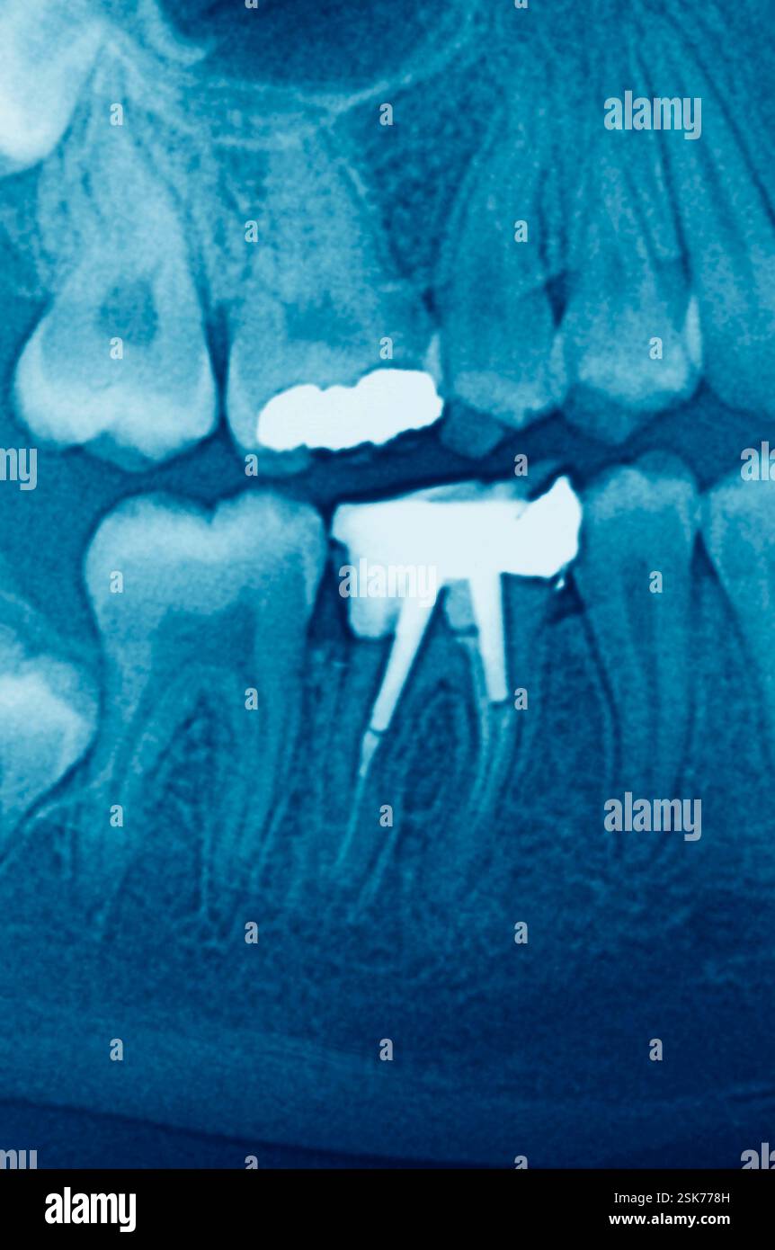 Dental crown, X-ray. The crown, the pivots it rests on, and an amalgam ...