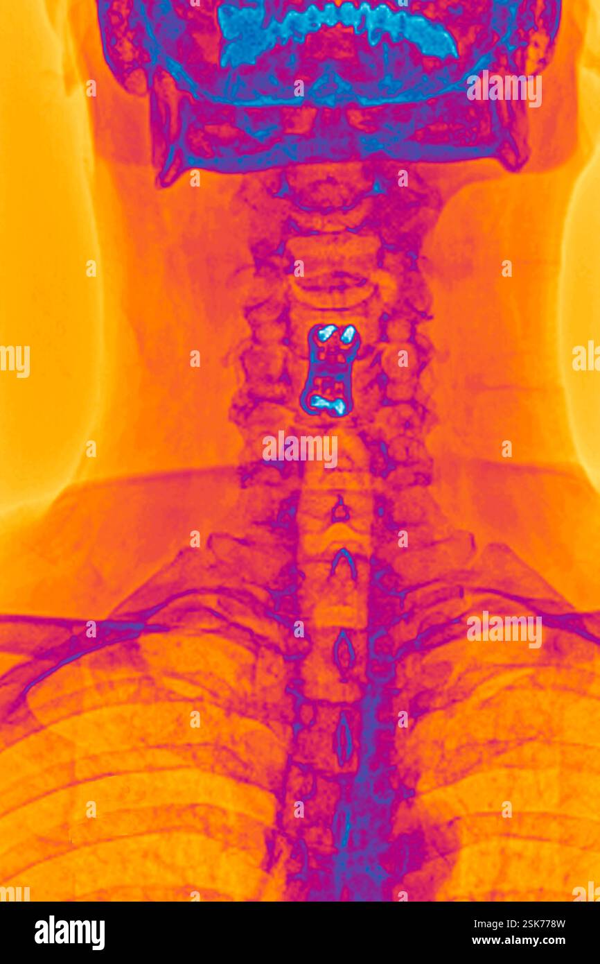 Treatment of neck arthritis. Frontal coloured X-ray of the neck of a 56 ...