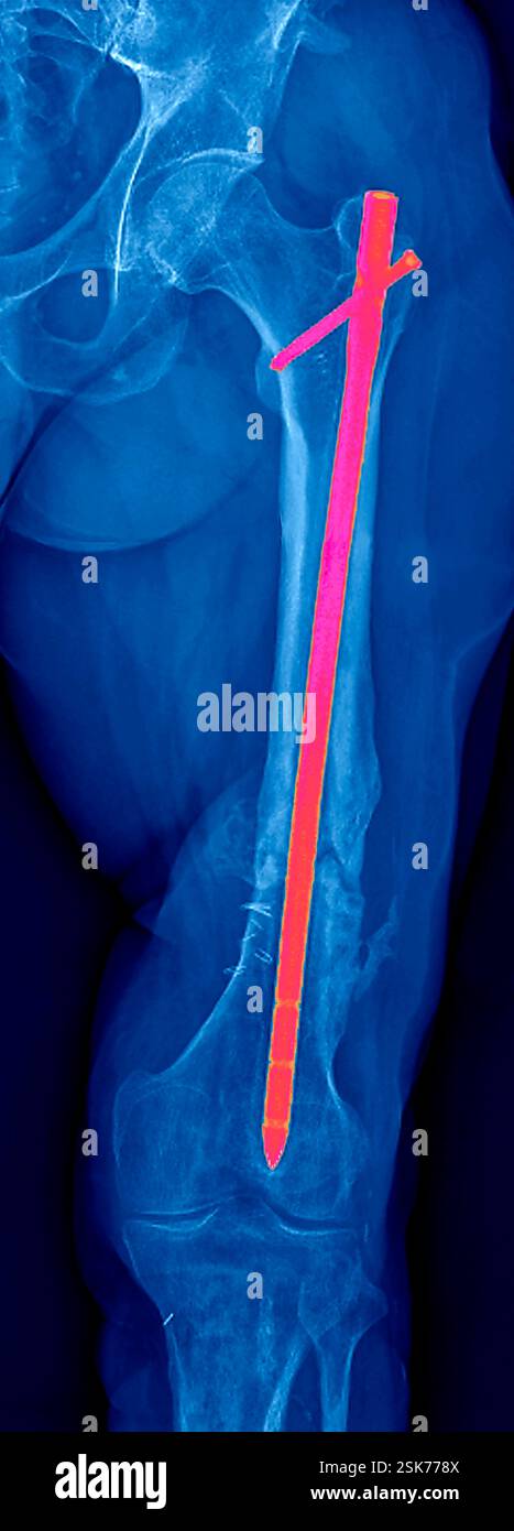 Pin in broken femur, coloured X-ray. The pin (red) has been inserted to ...