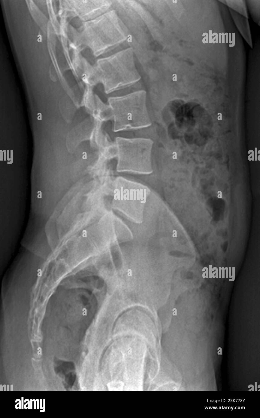 Normal lower spine. Profile X-ray of the normal lower spine of a 37 ...