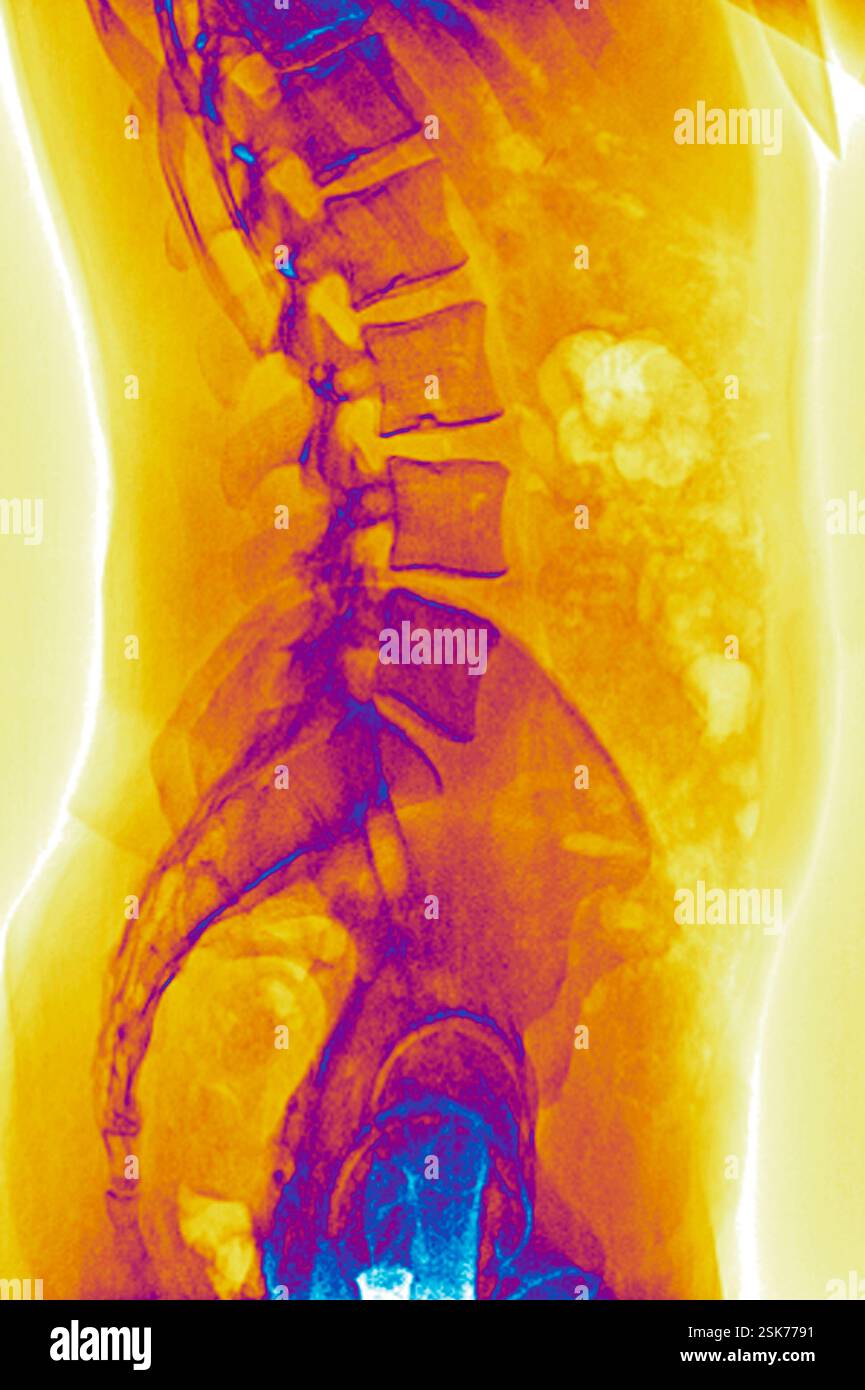 Normal lower spine. Coloured profile X-ray of the normal lower spine of ...