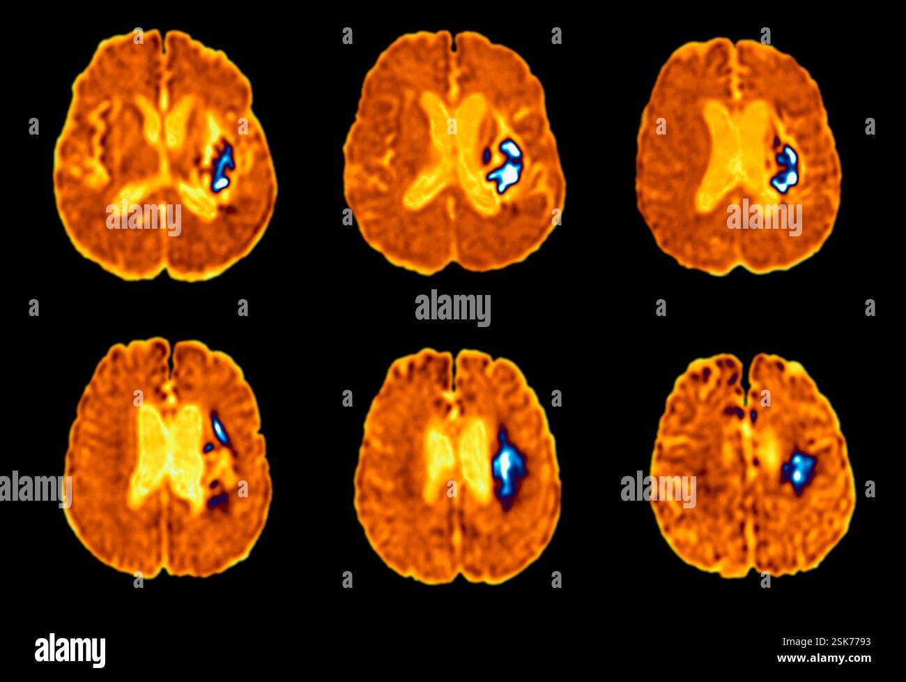 Stroke, coloured magnetic resonance imaging (MRI) brain scans. This is a haematoma (bleeding in ...