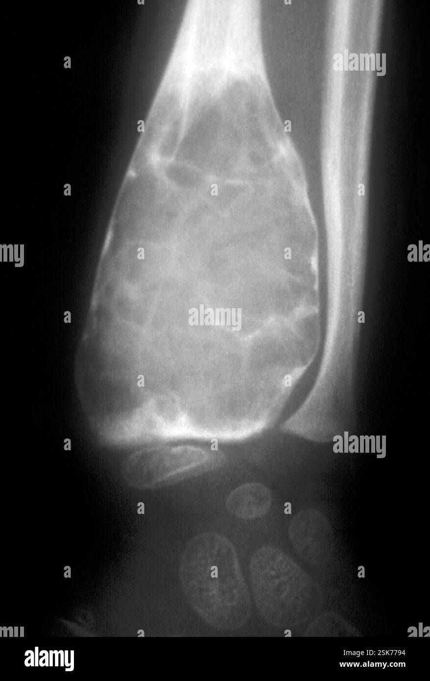 Benign bone tumour. Frontal X-ray of a patient's wrist, showing a large ...
