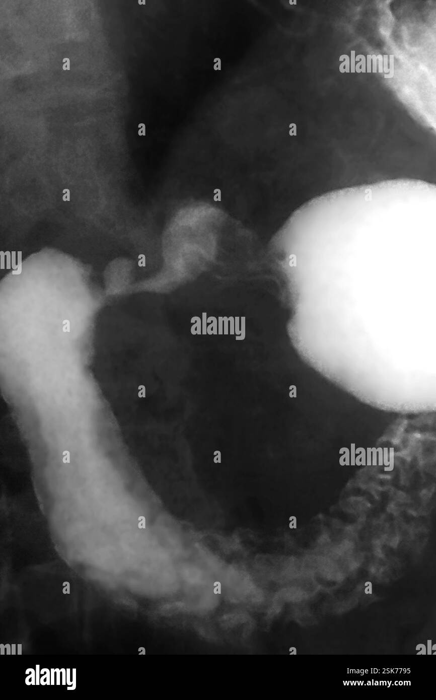 Duodenal ulcer, barium X-ray. This is a frontal view of the stomach ...