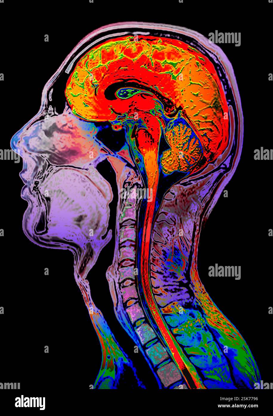 Normal brain, coloured magnetic resonance imaging (MRI) scan. Sagittal (side) view of a human ...