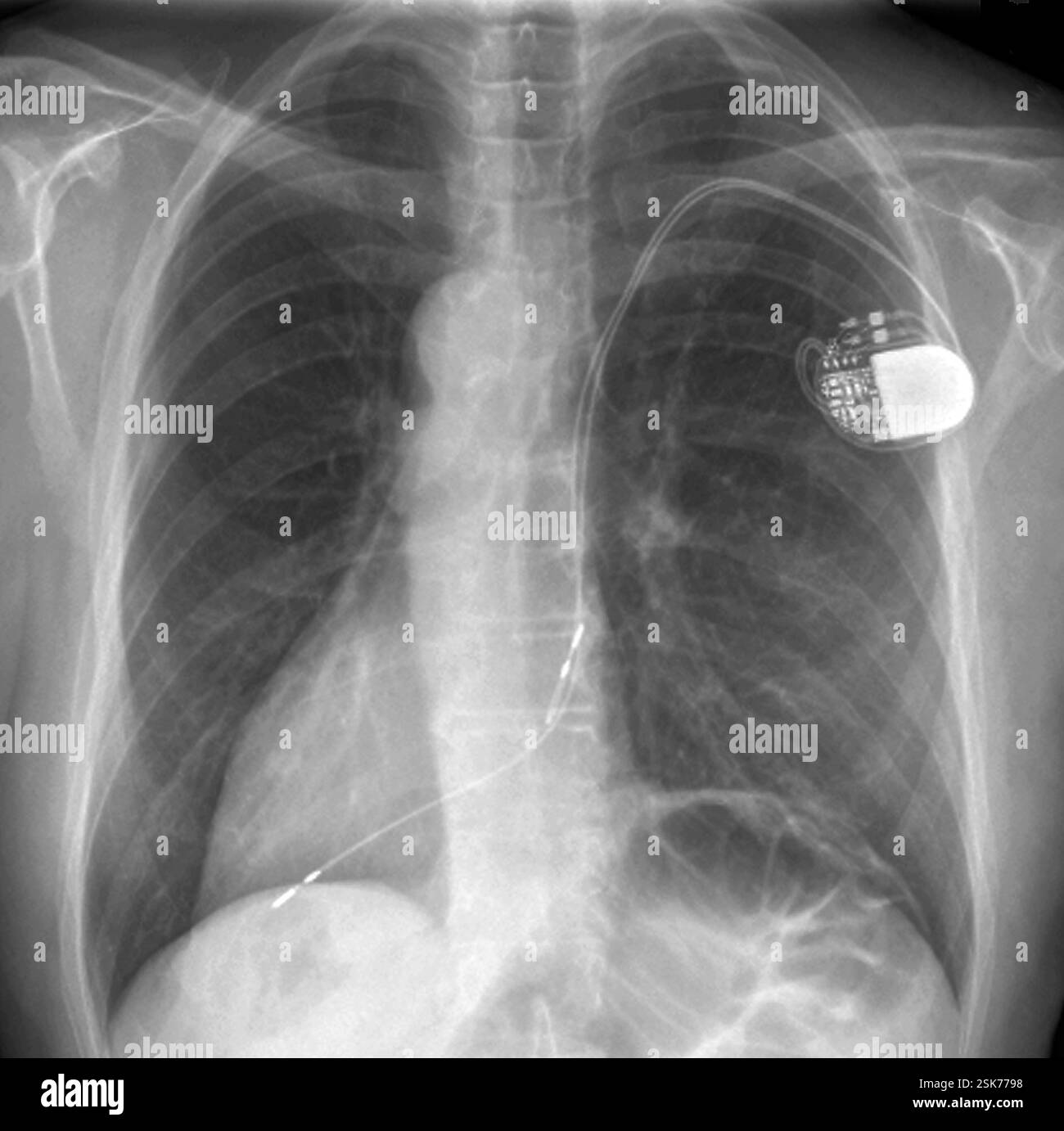 Inverted heart and pacemaker, X-ray Stock Photo - Alamy