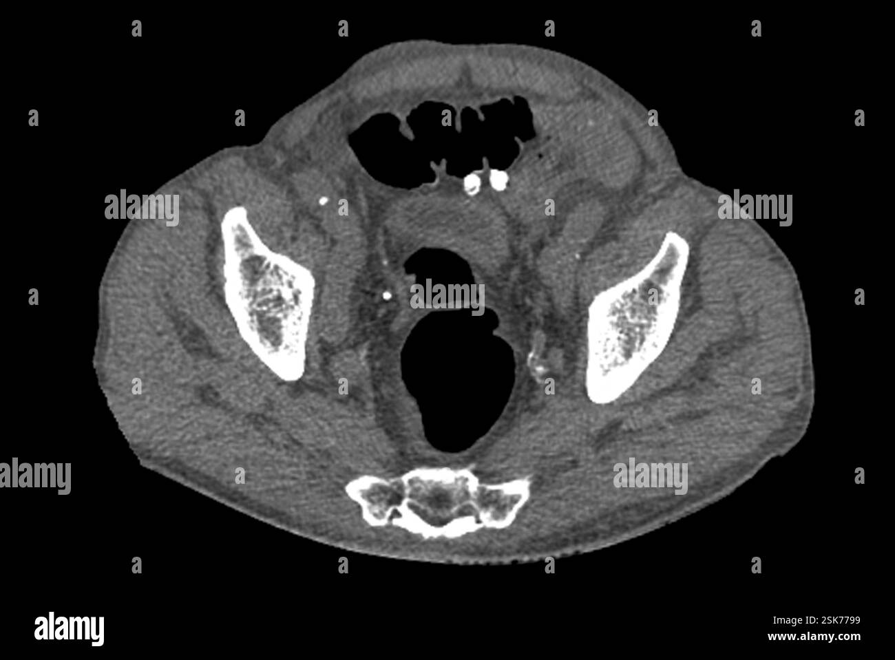 Diverticular disease, CT scan Stock Photo - Alamy
