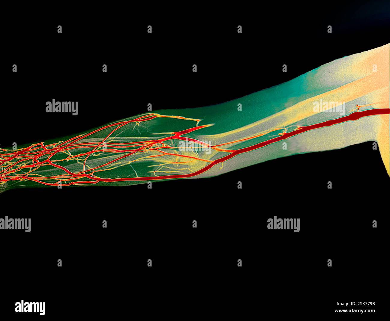 Arm veins, coloured X-ray. The veins (red) have been highlighted by the ...