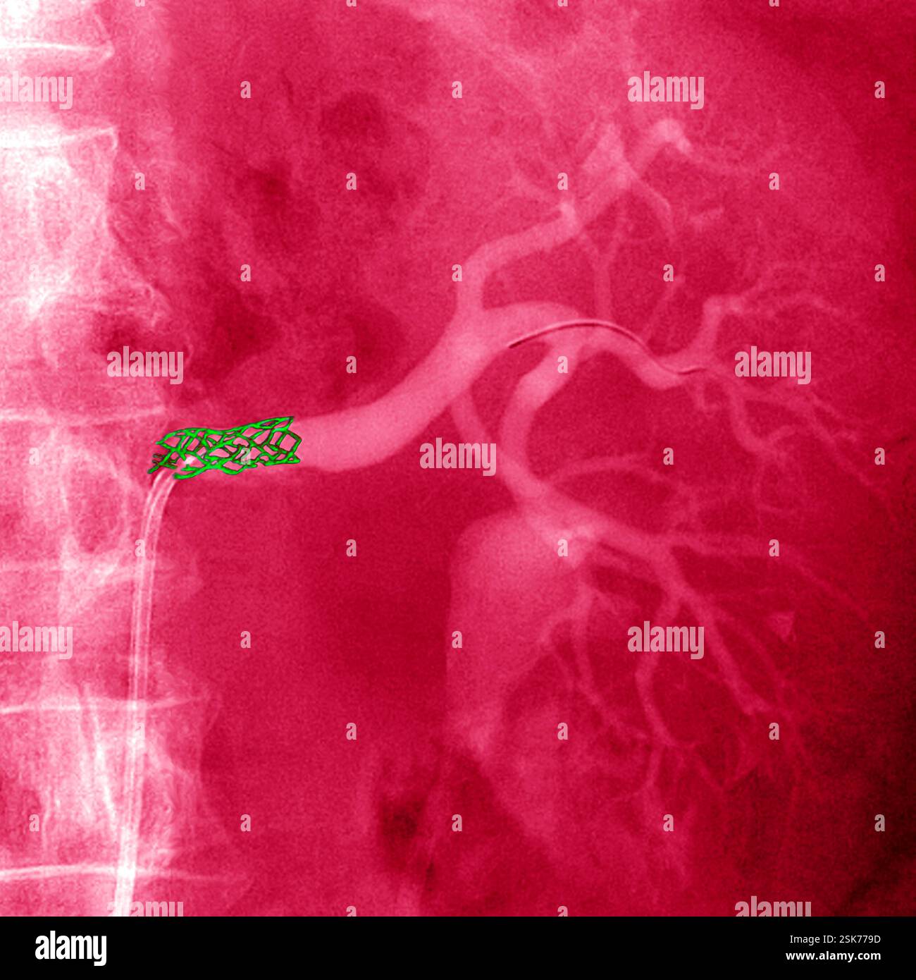 Arterial stent. Coloured X-ray angiogram of a stent (green, left) in ...
