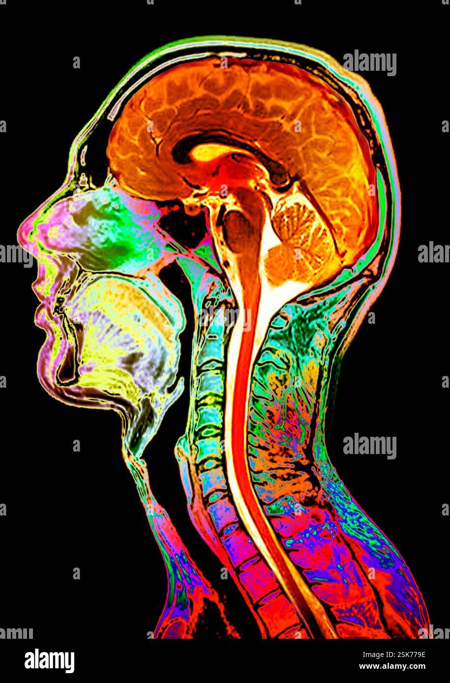 Normal brain, coloured magnetic resonance imaging (MRI) scan. Sagittal (side) view of a human ...