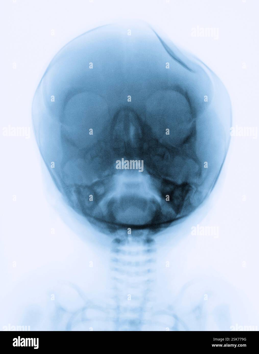Infant skull injury, X-ray. The injury (upper right) was caused by a ...