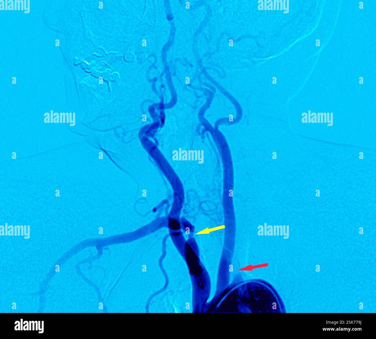 Blocked and narrowed arteries. Coloured angiogram of the neck of a 68 ...