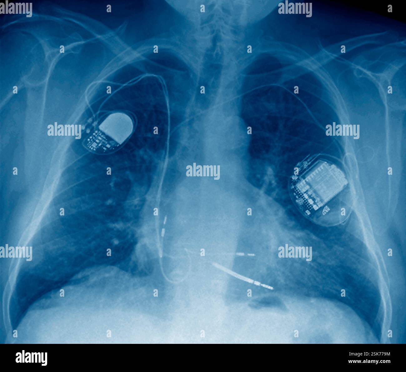 Cardiac stimulator and pacemaker. Frontal chest X-ray of a 57-year-old ...