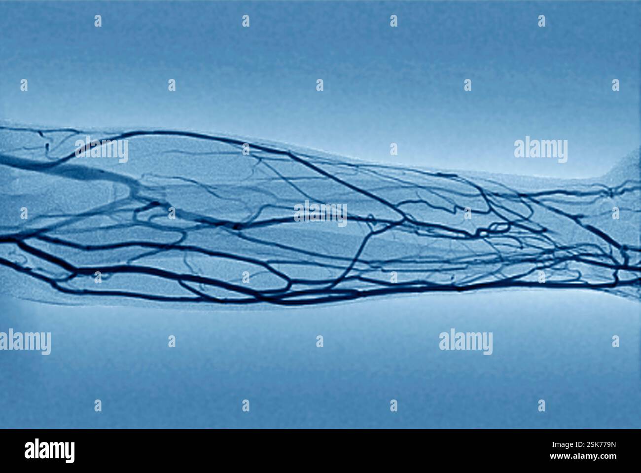 Arm veins, coloured X-ray. The veins (dark blue) have been highlighted ...