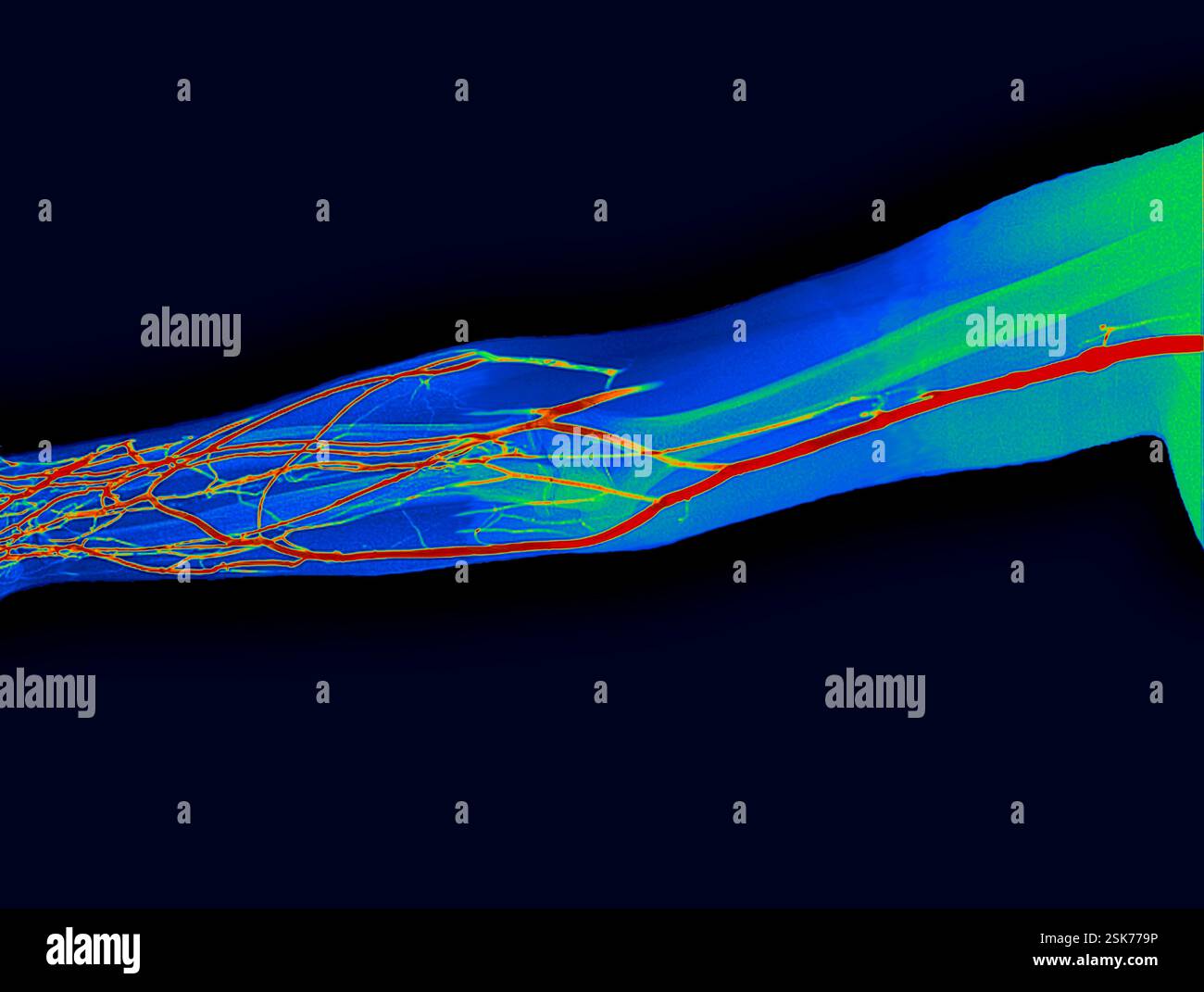 Arm veins, coloured X-ray. The veins (red) have been highlighted by the ...