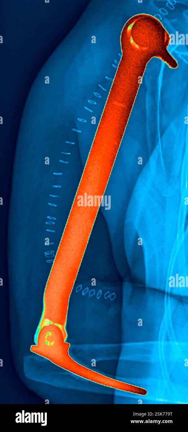 Total upper arm bone replacement. Coloured frontal X-ray of the right ...