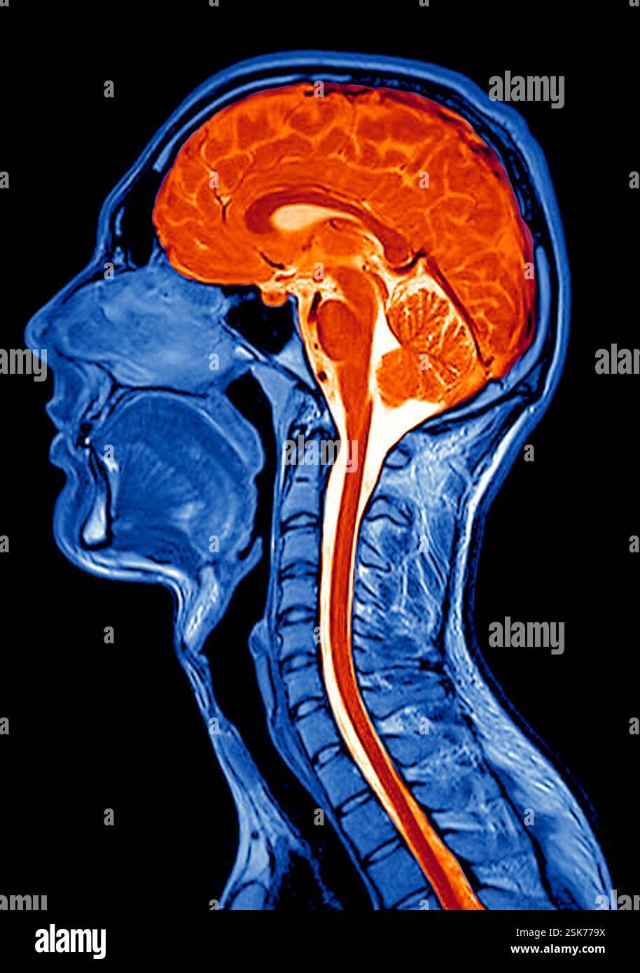 Normal brain, coloured magnetic resonance imaging (MRI) scan. Sagittal (side) view of a human ...