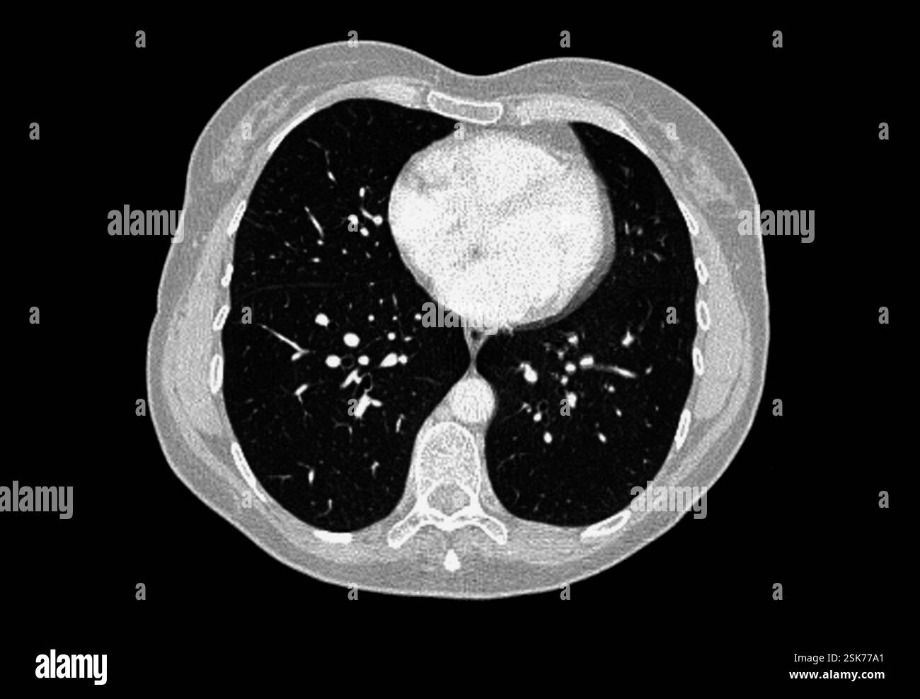 Normal lungs and heart. Computed tomography (CT) scan of an axial section through a person's ...