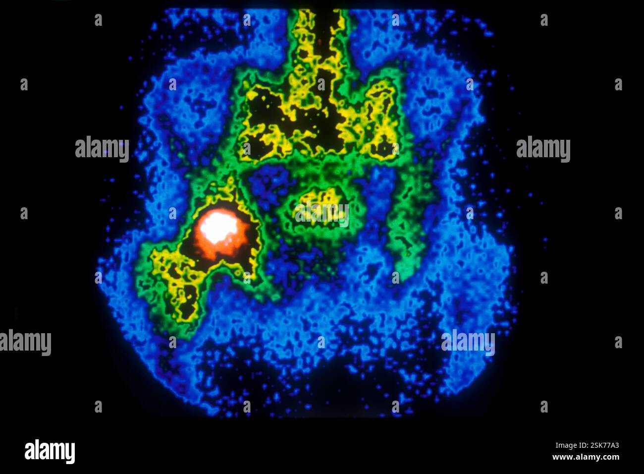 Secondary cancer of the femur, coloured scintigram. Frontal bone scan ...