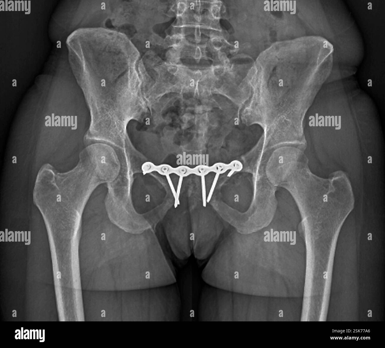 Pinned broken pelvis. Frontal X-ray of a 34-year-old woman's fractured ...