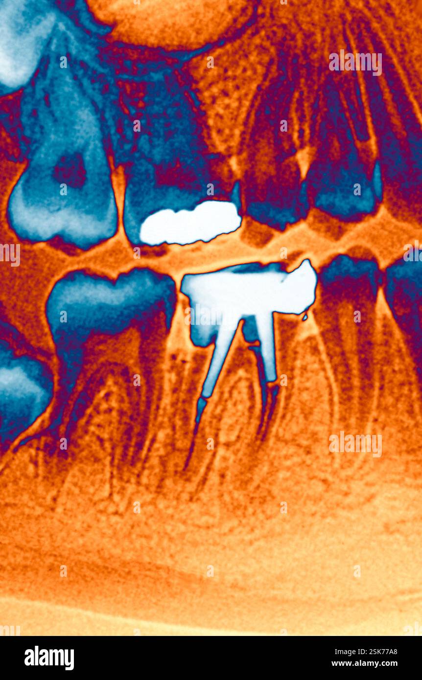 Dental crown, coloured X-ray. The crown, the pivots it rests on, and an ...