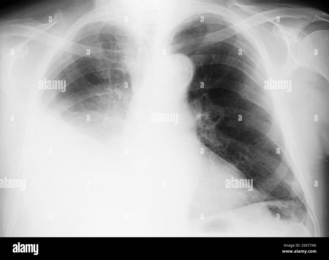 Pulmonary oedema, X-ray Stock Photo - Alamy
