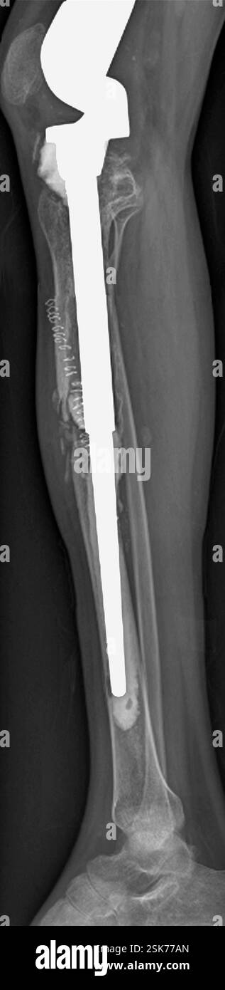 Knee replacement and tibial pin, X-ray. This side view of the right ...